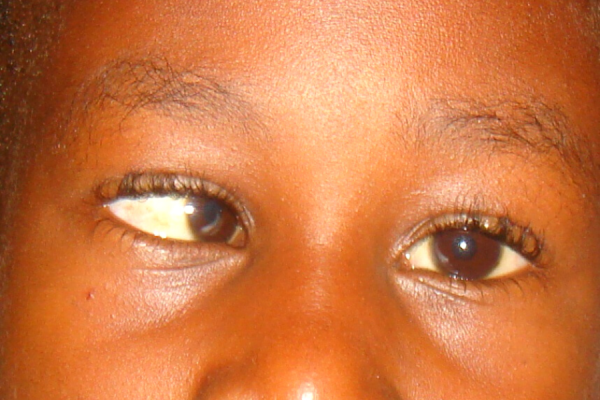 Squint Treatment – Eagle Eye